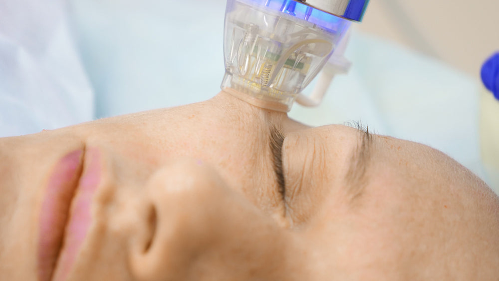 Face RF Micro-needling – Ai Skin Clinic